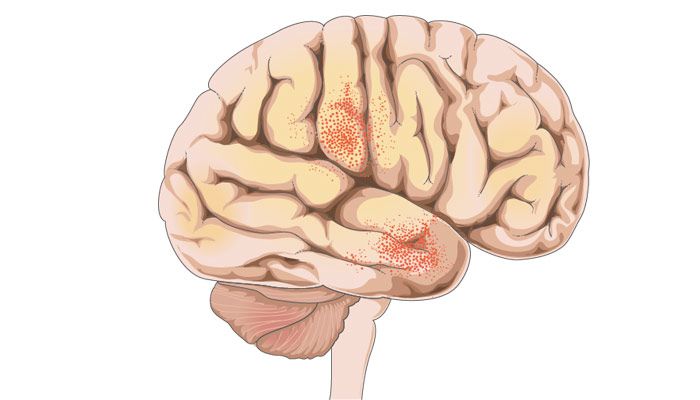 Meningitis Neonatal Por Vhs