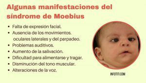 Síndrome de Moebius: señales de alerta, diagnóstico y tratamiento