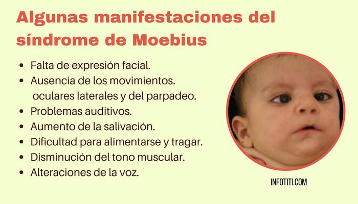 Síndrome de Moebius: señales de alerta, diagnóstico y tratamiento