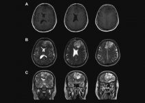 Inflamación del cerebro: definición, causas, síntomas y diagnóstico | TiTi