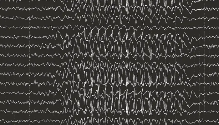 Epilepsia Occipital Benigna de la Niñez tipo Panayiotopoulos