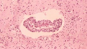 Encefalitis letárgica: síntomas, causas y diagnóstico