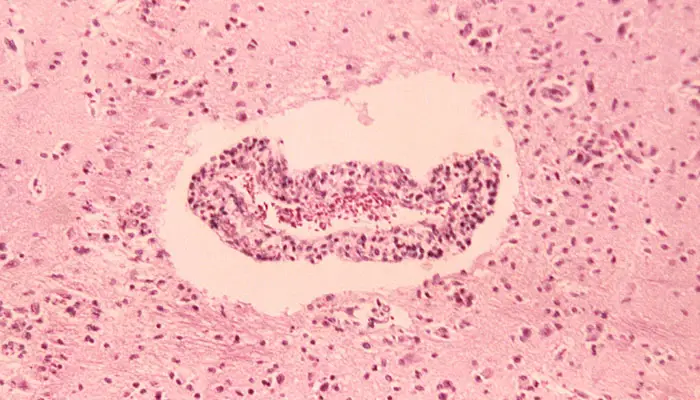 Encefalitis letárgica: síntomas, causas y diagnóstico