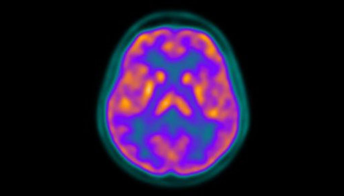 Encefalitis letárgica: síntomas, causas y diagnóstico