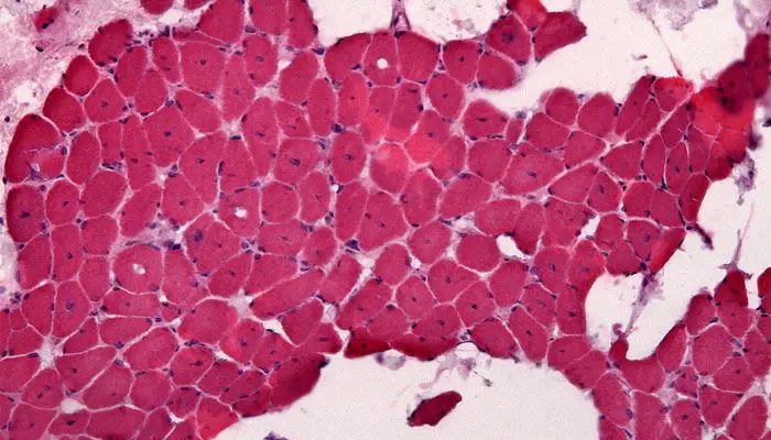 Miopatía: tipos, diagnóstico y tratamiento | Neurología